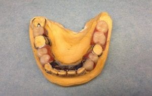 EZ Partial Fix Denture Repair Kit - Dental Creations, Ltd.